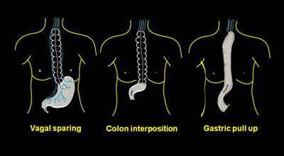 Esophagectomy | Memorial Hermann